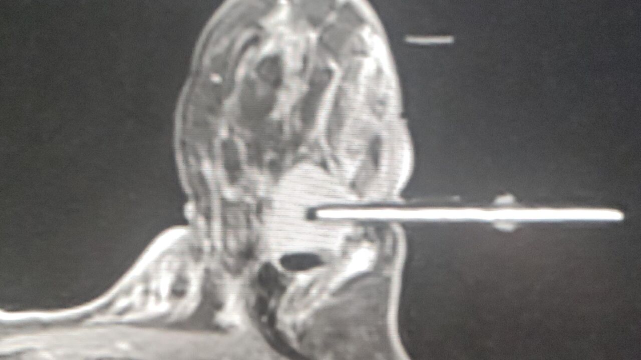 Así se realizan las biopsias con aguja de vacío de mama guiada con ...